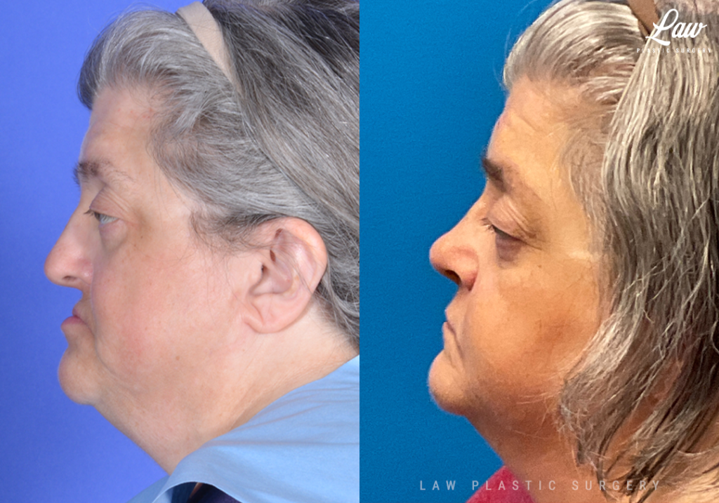 Jaw Distraction Before & After Photos - Sage Plastic Surgery