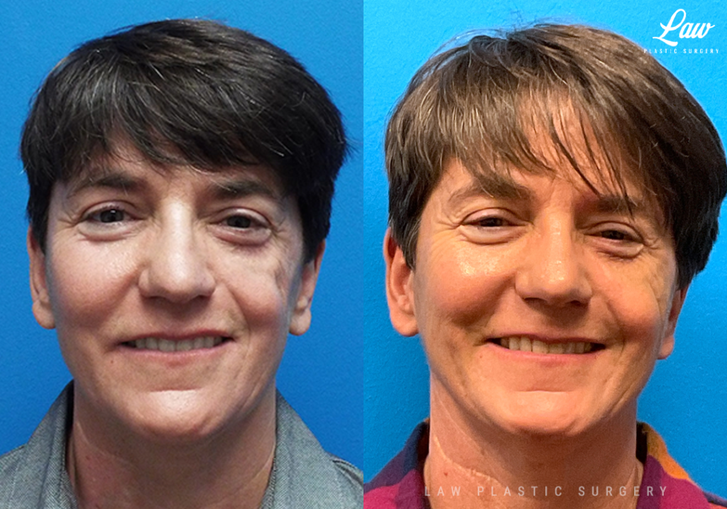 Parry Romberg Syndrome Before & After Photos - Sage Plastic Surgery