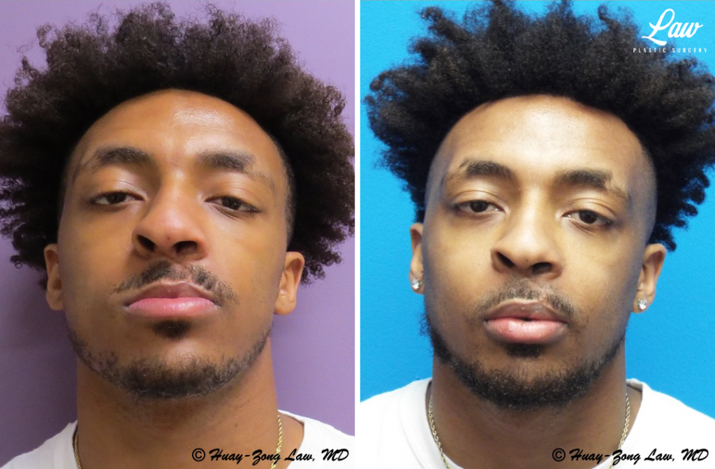 Jaw Surgery Before & After Photos - Sage Plastic Surgery