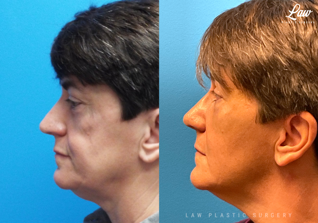 Parry Romberg Syndrome Before & After Photos - Sage Plastic Surgery