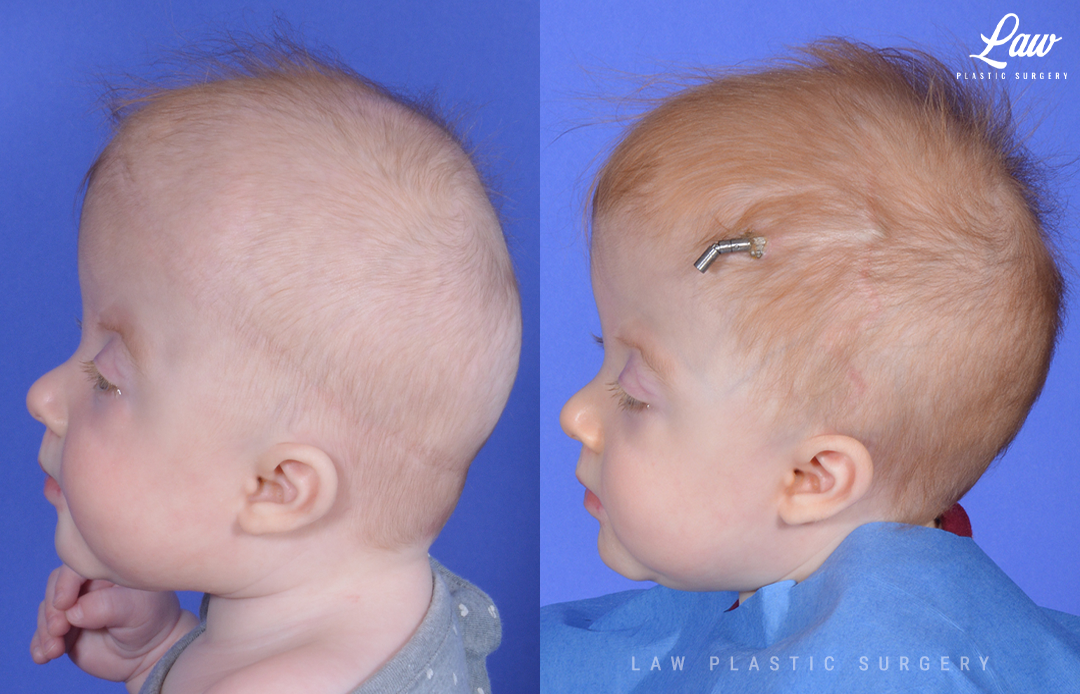 Craniosynostosis Before After Photos Sage Plastic Surgery
