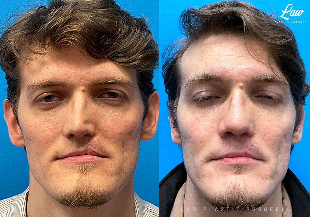 Cleft Lip Repair, Secondary and Adult Before & After Photos - Sage ...