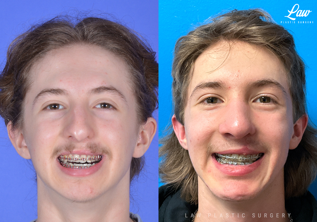 Jaw Surgery Before & After Photos - Sage Plastic Surgery