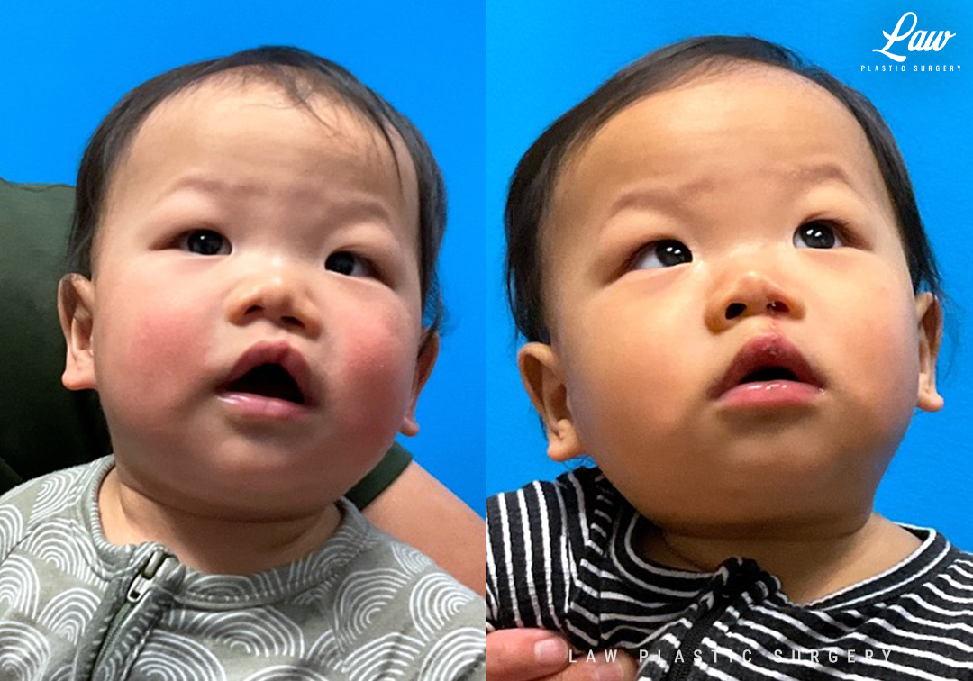 Cleft Lip Repair, Primary Unilateral Before & After Photos - Sage ...