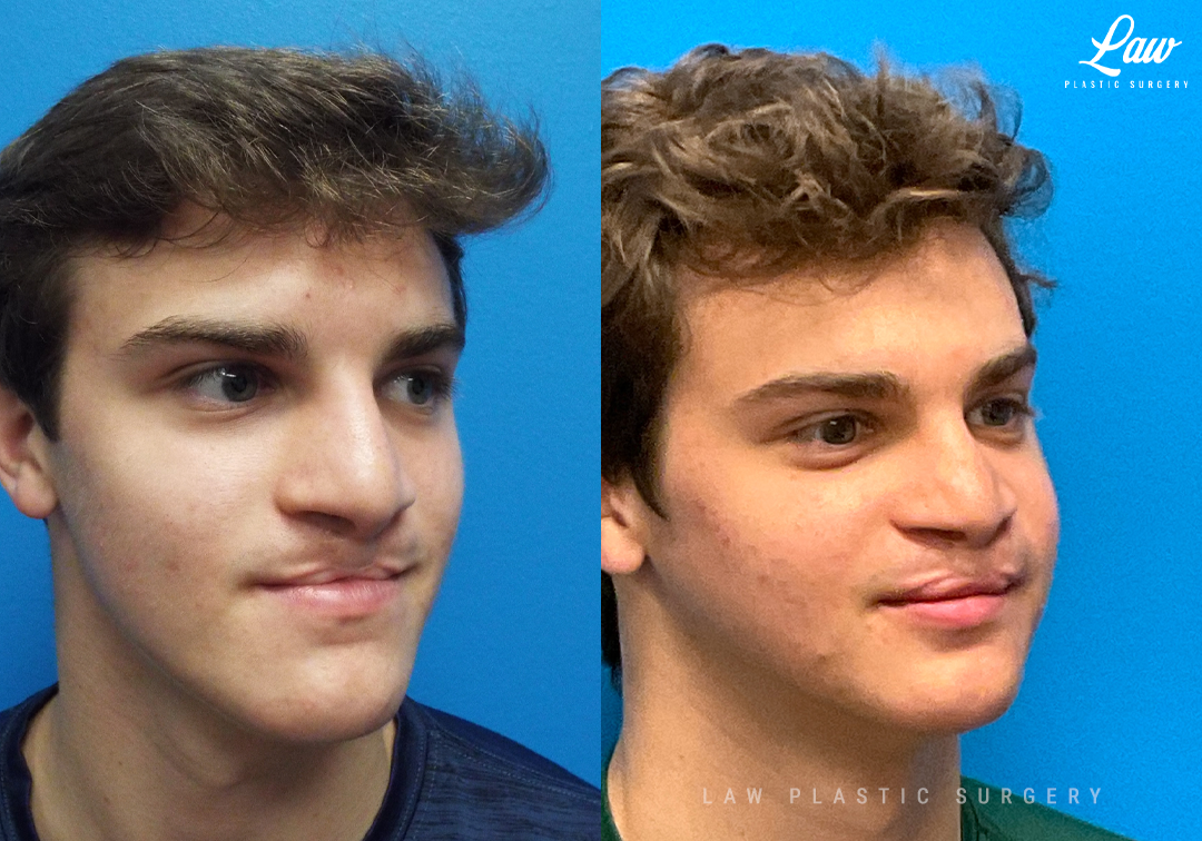 Jaw Surgery Before & After Photos - Sage Plastic Surgery