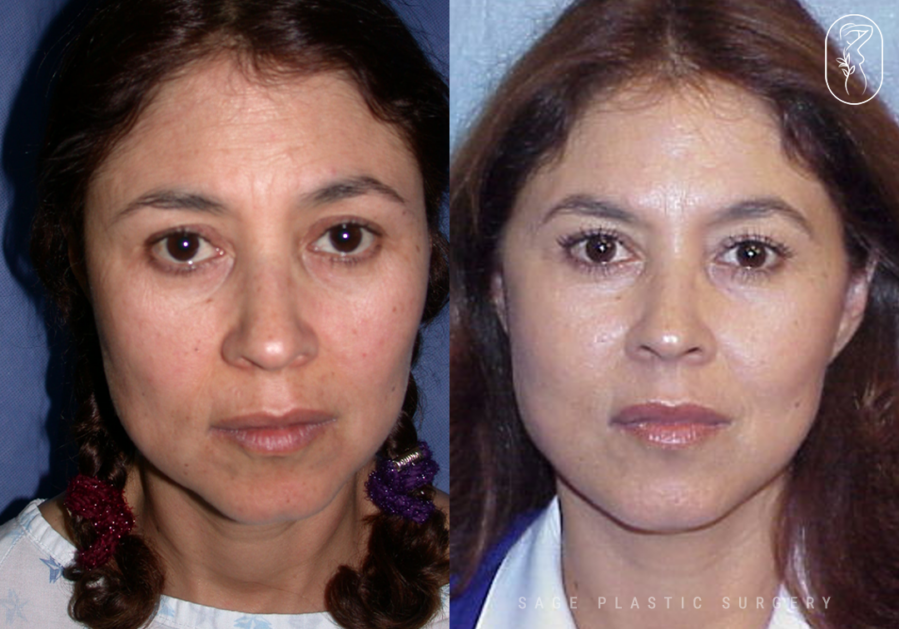 Neck Lift Before & After Photos - Sage Plastic Surgery
